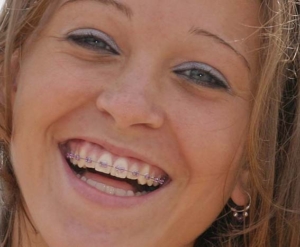 Vaste beugel - Orthodontiepraktijk Zaandam